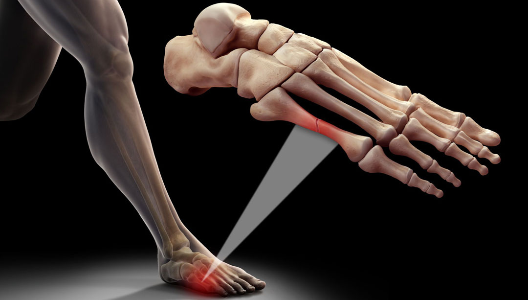 Fifth metatarsal fracture – telepatron